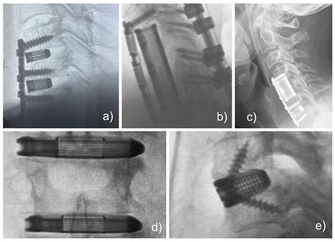 Advancements In Custom 3d Printed Titanium Interbody Spinal Fusion