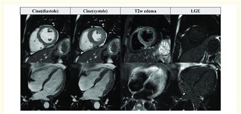 Magnetic Resonance Imaging Cardiac Magnetic Resonance Imaging On Day