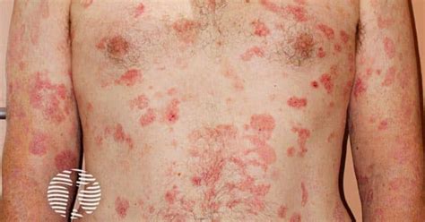Cutaneous T Cell Lymphoma Image
