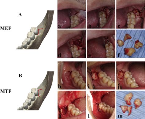 Modified Envelope Flap A Novel Incision Design Can Relieve