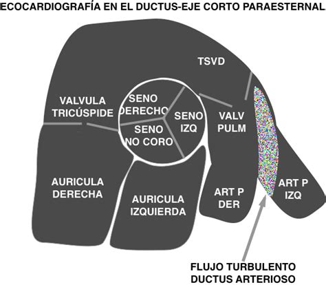 Ductus Arterioso Persistente Medicina Vascular