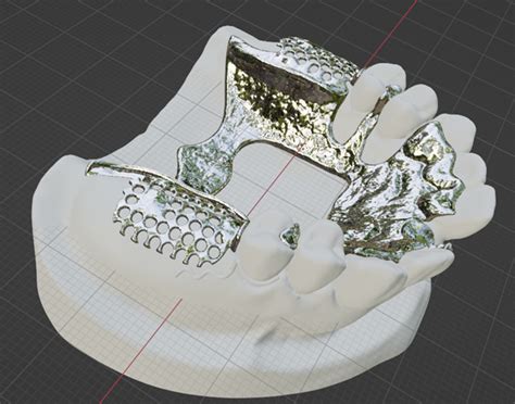 Archivo Stl Prosthodontics Kennedy Class I Mod 1 Maxillary Removable