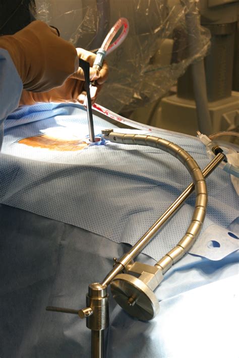 Microdiscectomy Eeric Truumees Md