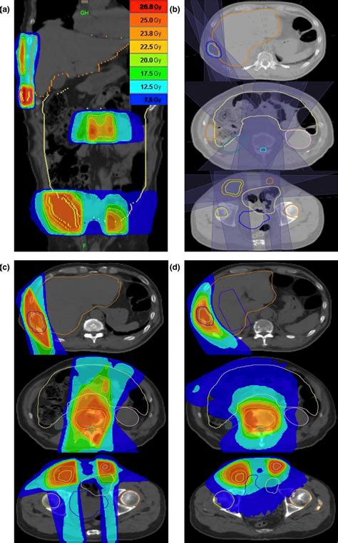 dose distributions for multiple bone and lymph node metastases using