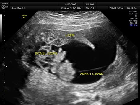 Limb Body Wall Complex Or Body Stalk Complex Looking Through A Transducer