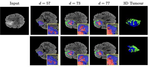 X Diffusion Generating Detailed 3d Mri Volumes From A Single Image