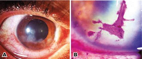 Disciform Keratitis Vs Interstitial Keratitis