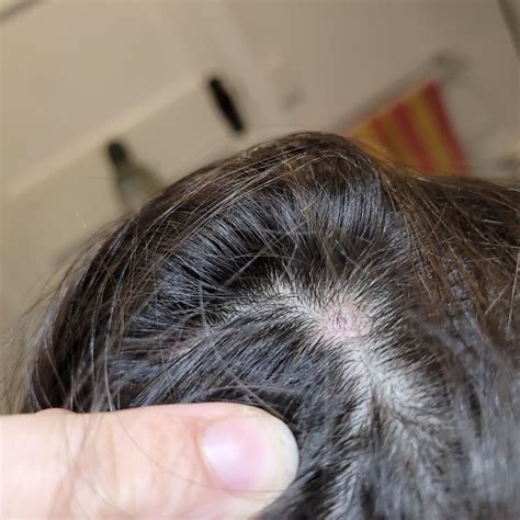 Itchy Scalp Rashlesions Rdermatology