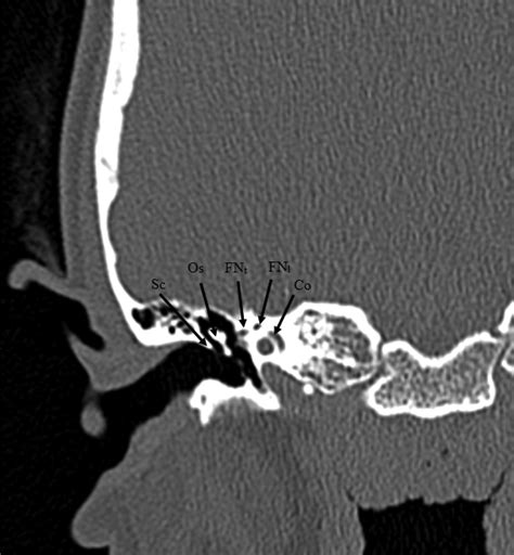 Radiology Of Acute Mastoiditis And Its Complications A Pictorial