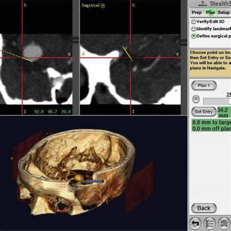Automated 3 D Volume Rendered Angio Ct By Medtronic Stealth Station