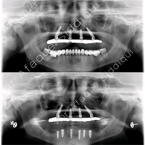 Dr Afaque Habib Siddiqui On Linkedin Allon4 Allon6 Nobelactive