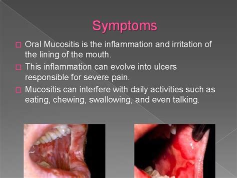 Low Level Laser Therapy For Oral Mucositis Ashlee