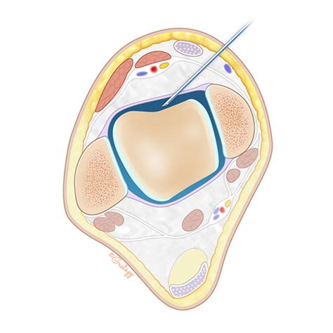 Tibiotalar Joint Effusion Ultrasound Guided Injection Training