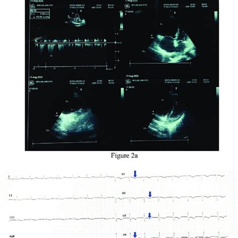 Initial 2d Echocardiography And Electrocardiography Findings