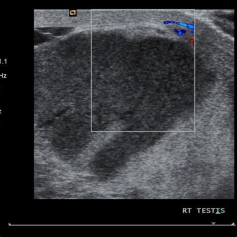Spiral “twirling Sign” Of The Spermatic Cord In Testicular High