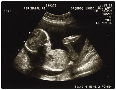 23 Weeks Ultrasound Report