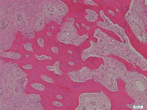 Peripheral Ossifying Fibroma Histopathology