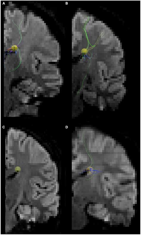 Insular Cortex Mri