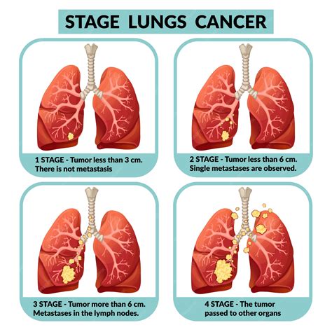 Premium Vector Stages Of Lungs Cancer