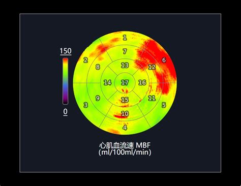 Ctp心肌灌注智能分析系统 心肌灌注人工智能 Ai影像辅助诊断系统 联影智能