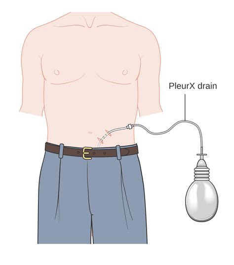 File Diagram Showing A Pleurx Drain Attached To The Drainage Bottle