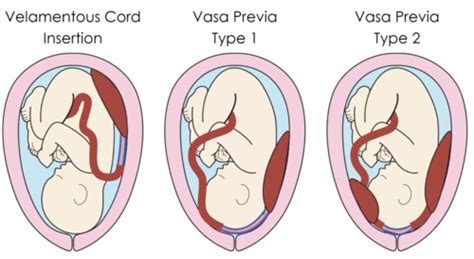 Disorders Of The Placenta Flashcards Quizlet