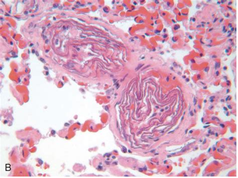 Path Embolism Infarction Shock Flashcards Quizlet