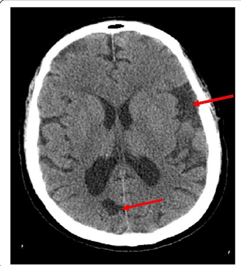 Computed Tomography Scan Of Brain Without Contrast Showing Brain Download Scientific Diagram