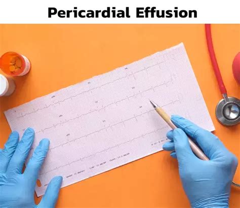 Pericardial Effusion Health Advisor Pericardial Effusion Health Advisor