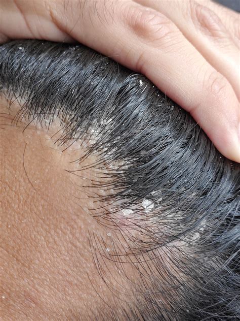 Dry Scalp Fungus Treatment At Willie Mixon Blog