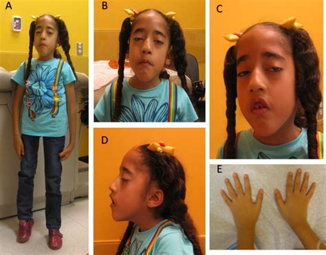 Identification Of Stac3 Variants In Non Native American Families With Overlapping Features Of