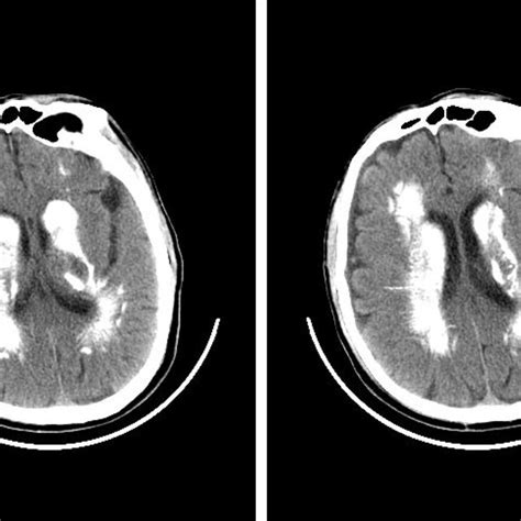Computed Tomography Of The Brain Showed Multiple Calcifications In The Download Scientific