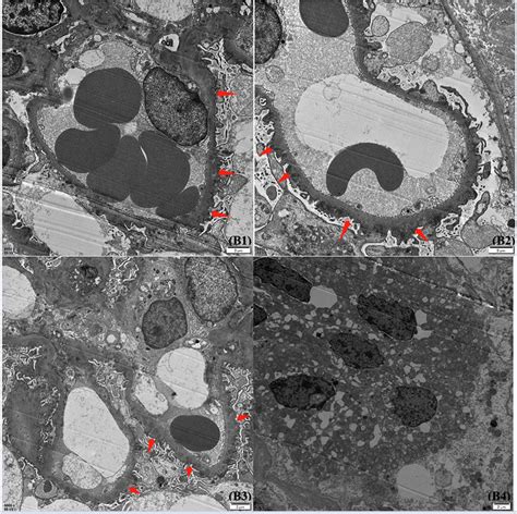 Glomerular Findings By Electron Microscope Under An Electron Download Scientific Diagram