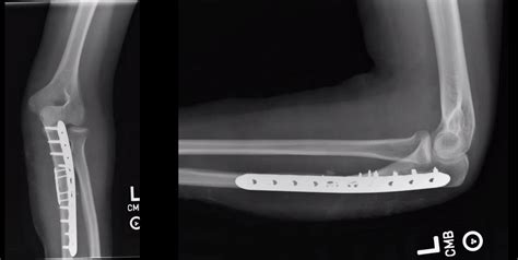 Monteggia Fracture Orif