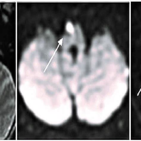 Acute Diffusion Defect Was Detected At The Anterior Paramedian Part Of Download Scientific