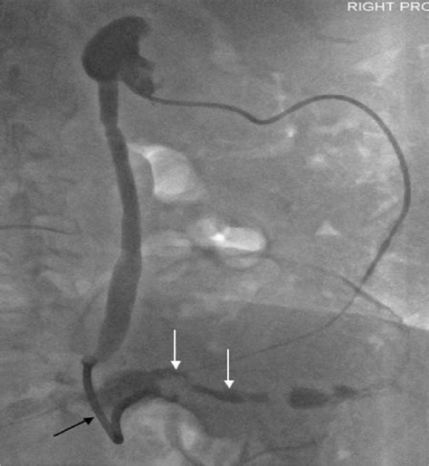 Nephrostogram Performed A Week After The Procedure Shows Free Flow Of Download Scientific