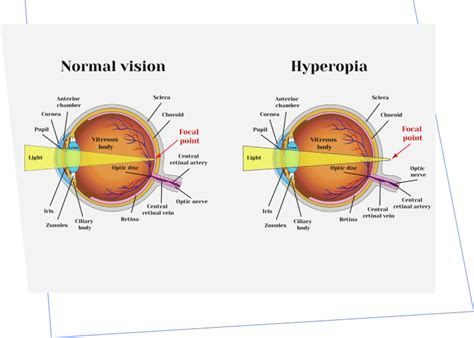 Hyperopia Treatment Laser Eye Surgery For Long Sightedness