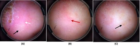 A Diffuse Erythema White Arrow Yellow Globules Or Yellow Tears