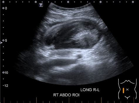 Figure 2 From Massive Appendiceal Mucinous Neoplasm Diagnosed After