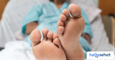 Ulkus Dekubitus Luka Baring Gejala Penyebab Dan Obat