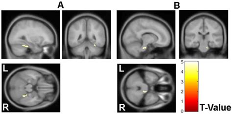 Vba Result Clusters With Significantly Decreased Fa Were Overlaid On Download Scientific