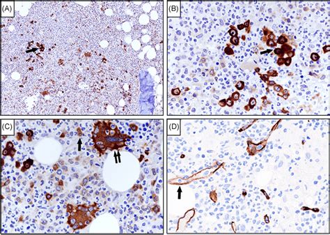 Npm1‐mutated Mds A Clusters Of Npm1 Cytoplasmic‐positive Cells Download Scientific Diagram