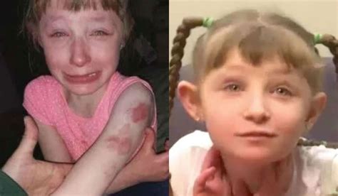 Una Nena De A Os Fue Brutalmente Mordida Por Una Compa Era De Clase Misionesonline