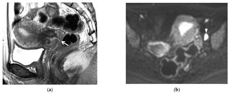 Uterus Anatomy Mri