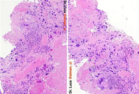Pleomorphic Carcinoma Pleomorphic Lung Carcinoma Is Compos… Flickr