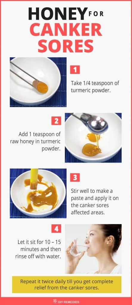 Home Remedies For Canker Sores