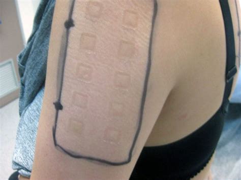 Allergy Patch Testing