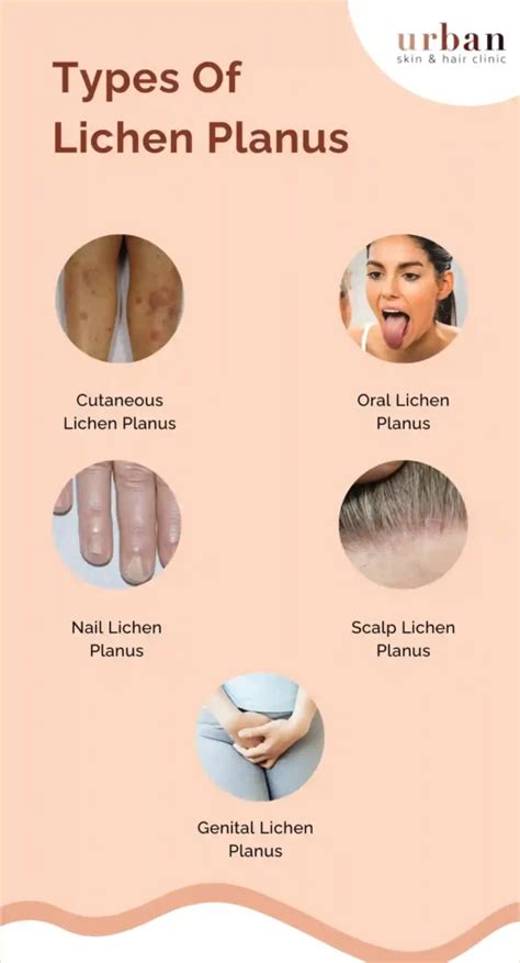 Lichen Planus Types Causes And Symptoms Ushc