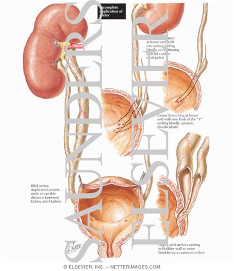 Incomplete Duplication Of Ureter