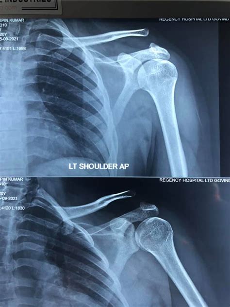 Acromioclavicular Dislocation Dr Daksh Orthocare Kanpur